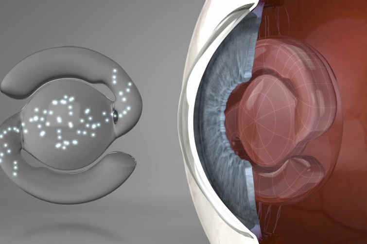 Trial for new IOL - eyeonoptics