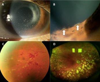 Sarcoidosis and the eye - nzoptics