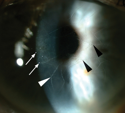 Getting granular on granular dystrophies - nzoptics