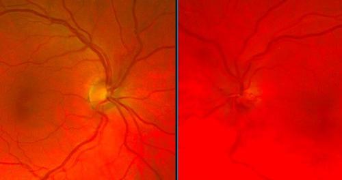 How does Covid-19 affect the eye? - nzoptics
